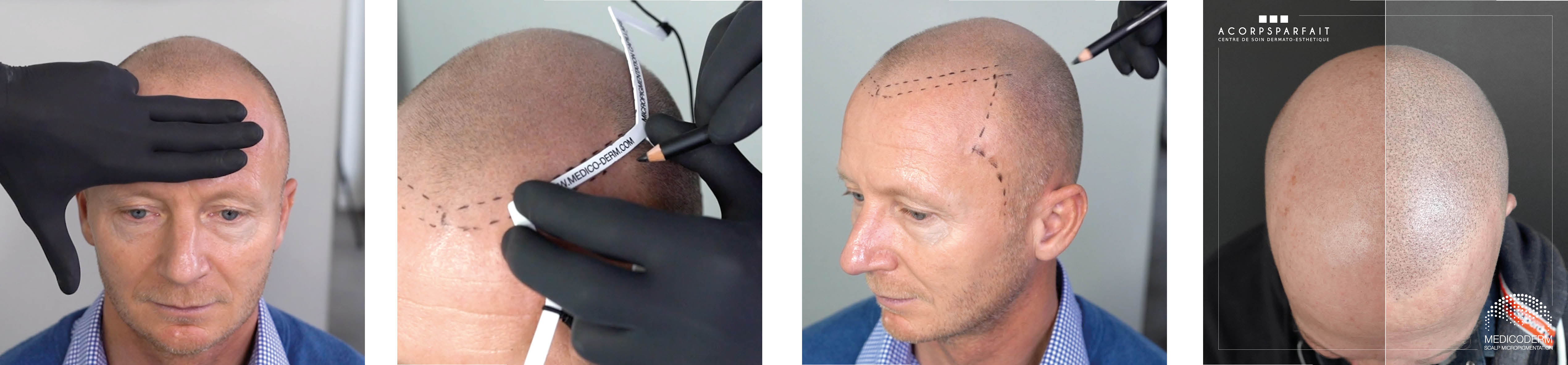 Comment réaliser la ligne frontale?