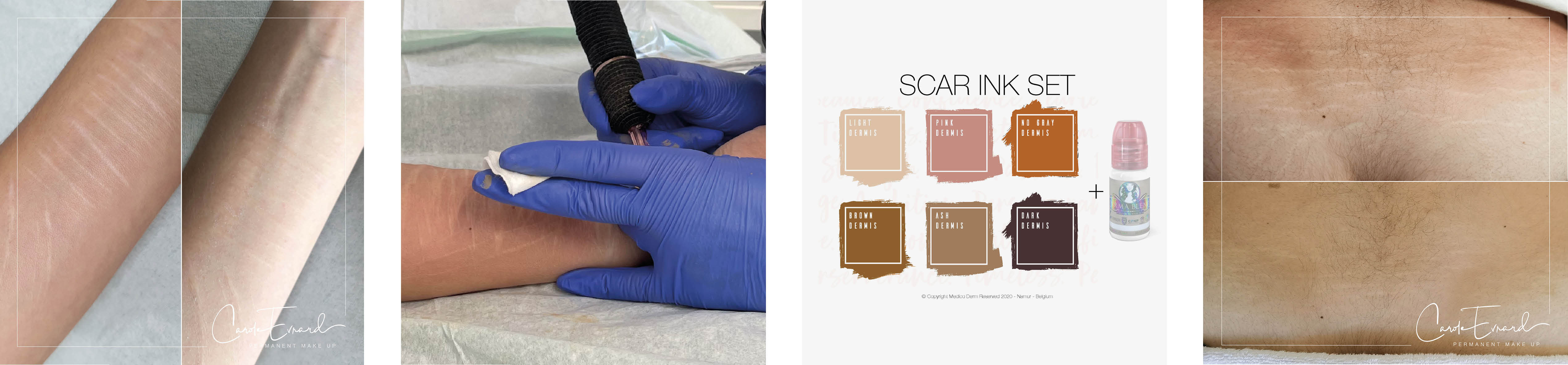 Technique de camouflage de cicatrices et vergetures