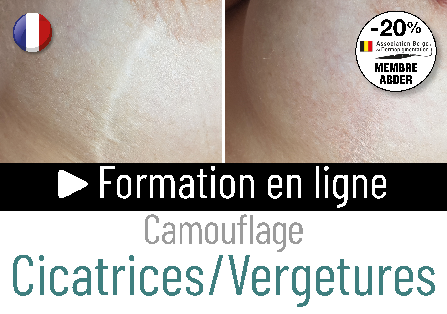 Technique de camouflage de cicatrices et vergetures