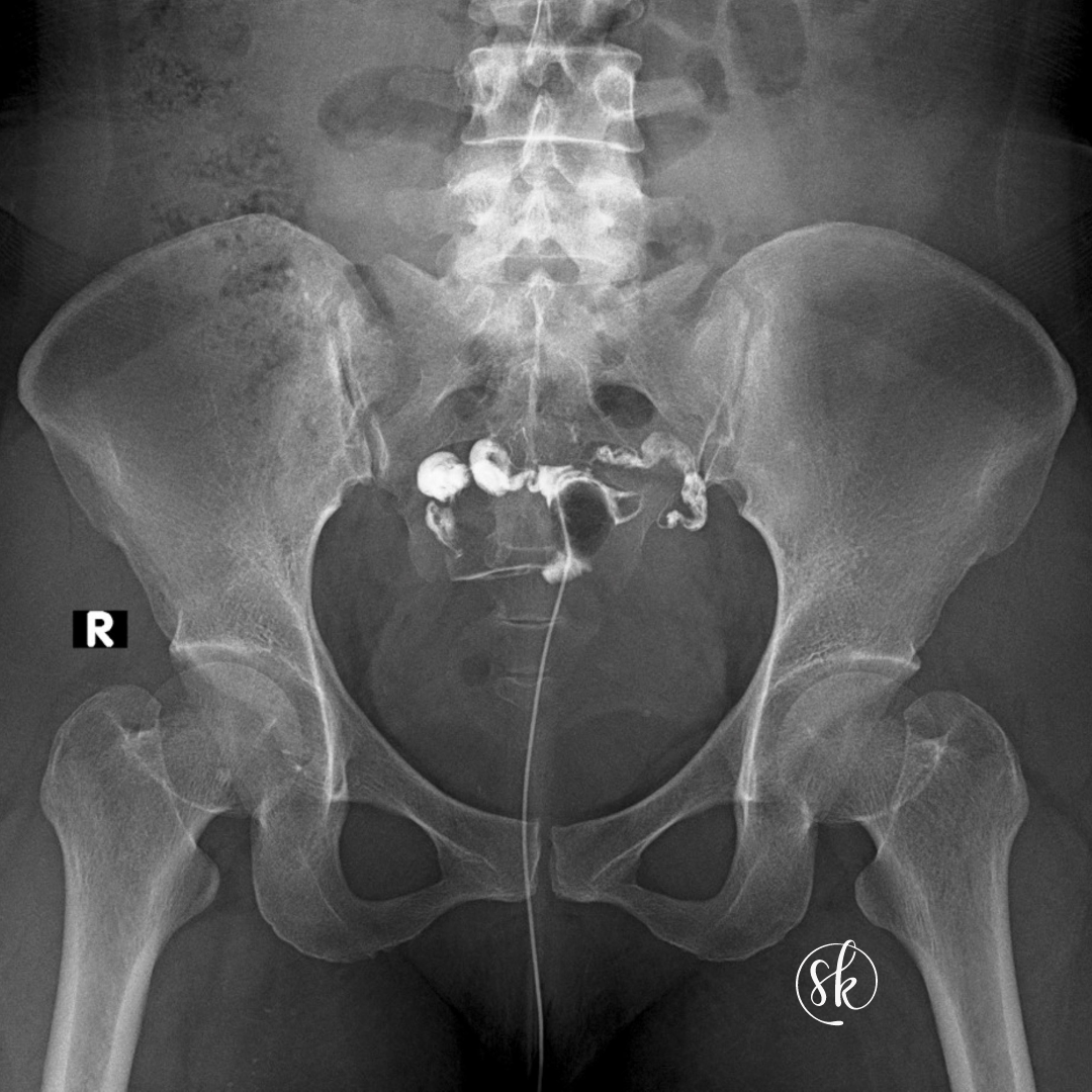 Ujian Tiub Fallopian: Apa Pilihan Yang Ada?