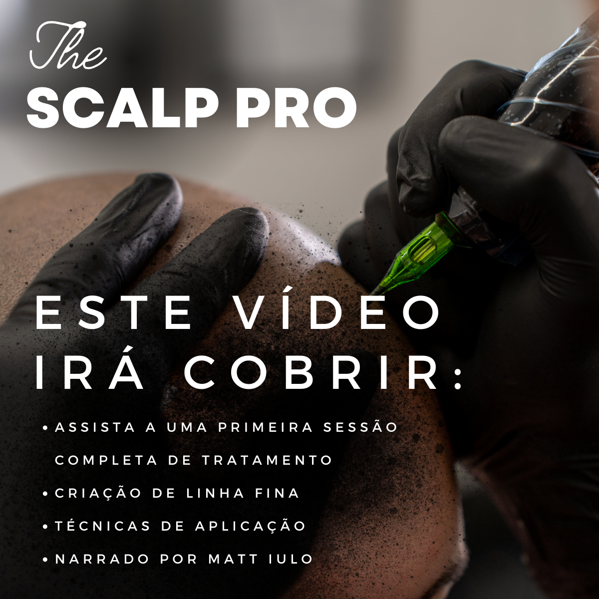 Primeira sessão de tratamento Norwood 5 (Portuguese)