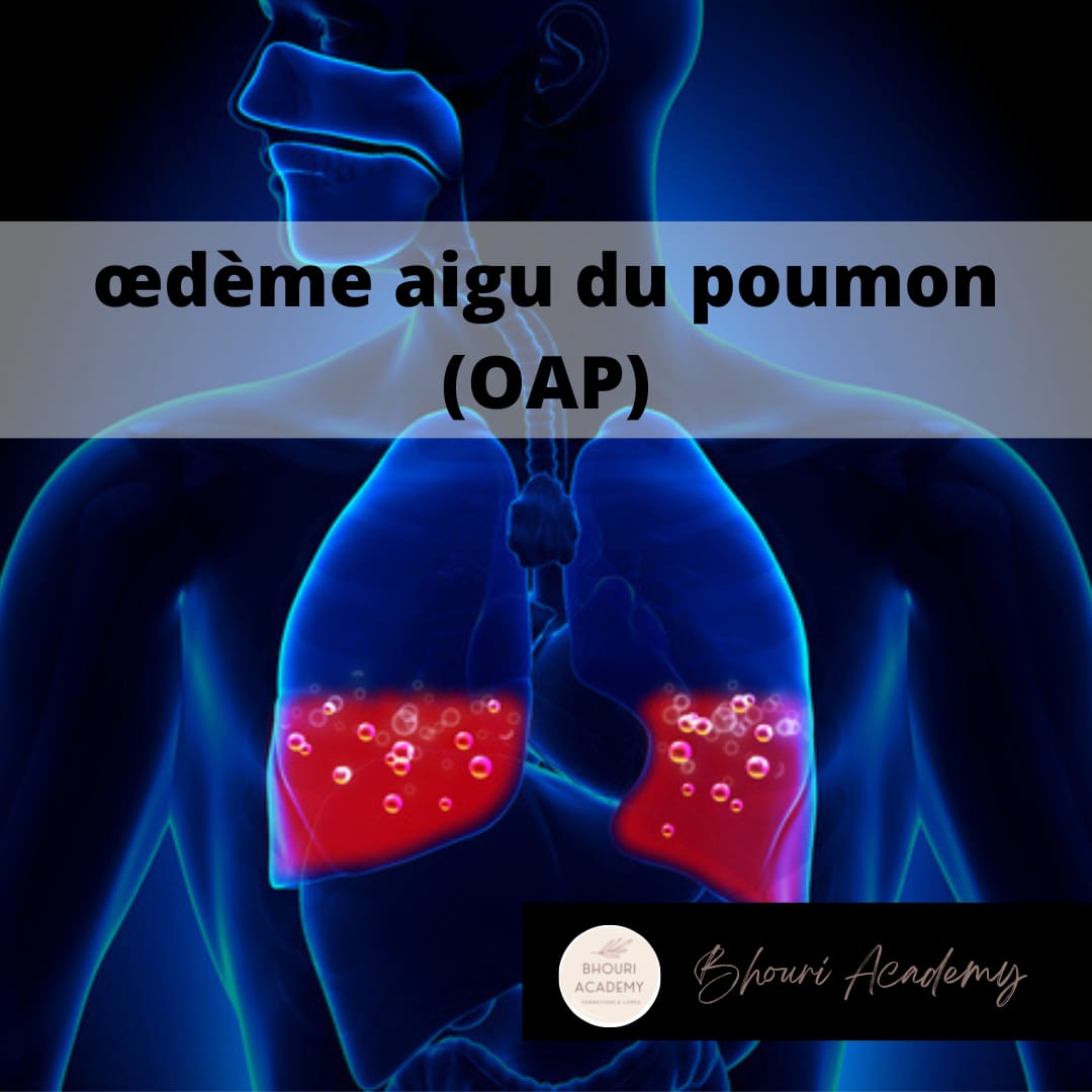 Oedème aigu du poumon